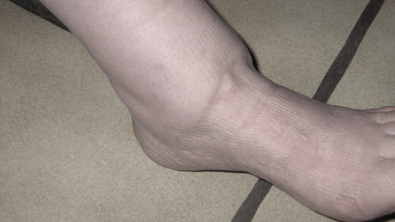 Lymfe- en Oedeem- therapie - Logister